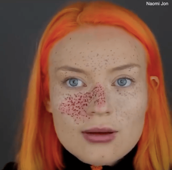 She Thought Henna Can Mask Her Acne Scars But It Turns Out DIsastrous!