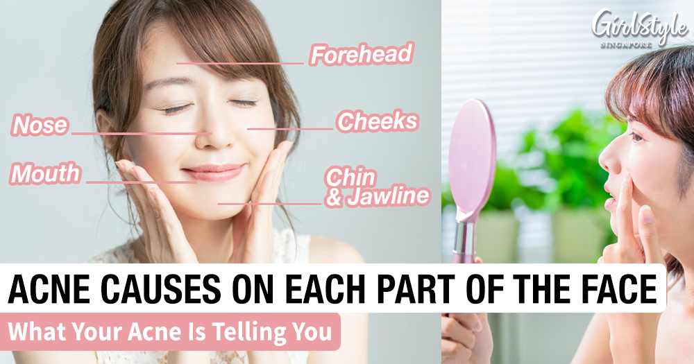 What's Triggering The Acne On Each Part Of Your Face