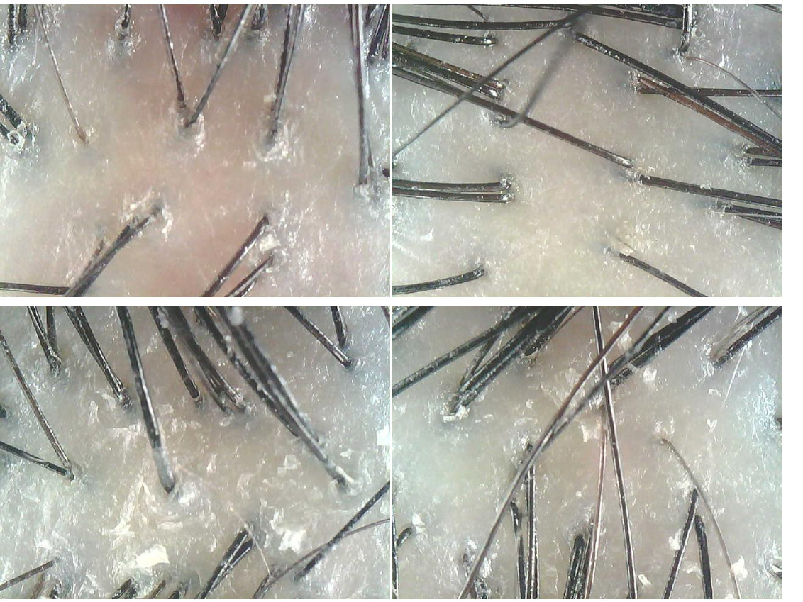 I Went For A Free Scalp Analysis To Get To The Root Cause Of All My ...