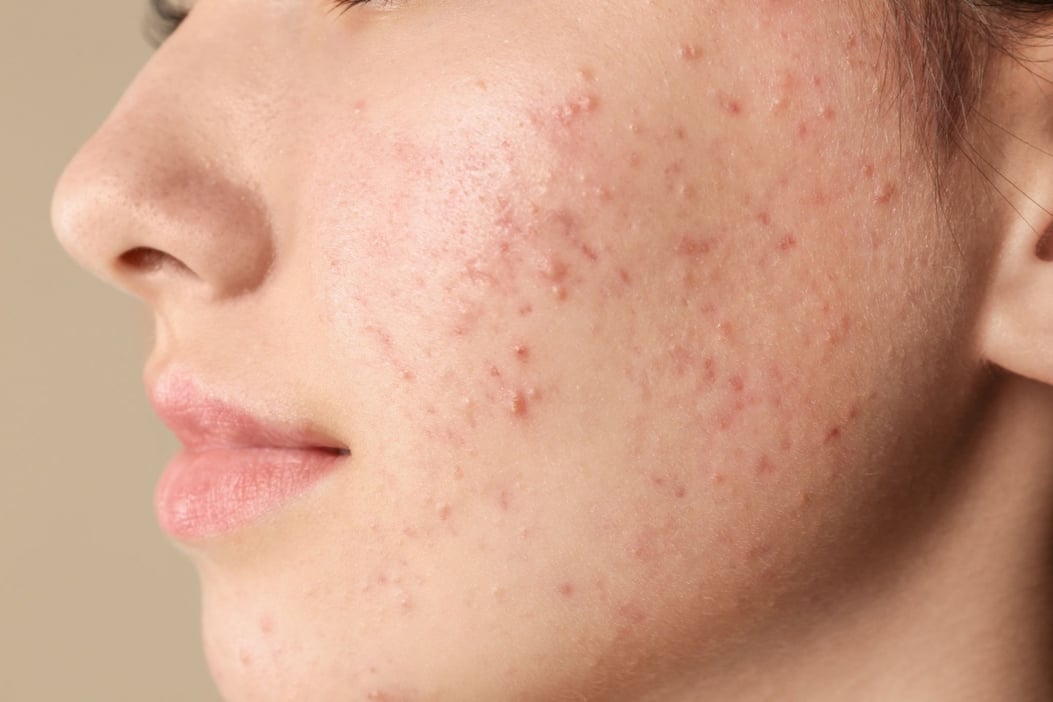 4 Reasons To Wear A Sunscreen Like Astalift D-UV Clear White Solution ...