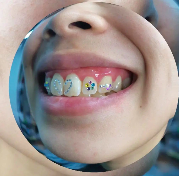 Sparkly Tooth Gems Are In And Here’s Where You Can Get Them Done In ...