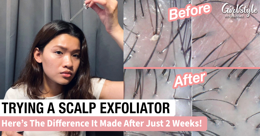 I Did A Scalp Exfoliation Treatment For 2 Weeks & Here’s How It ...