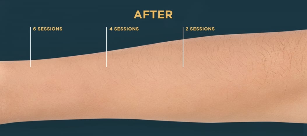 AFT Hair Removal at Strip: Removes Up To 80% Of Unwanted Hair!