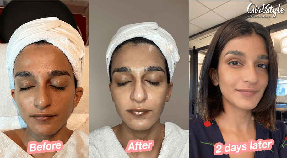 Can One Facial Session Give You A V-Shaped Face? Astalift's Lifting ...