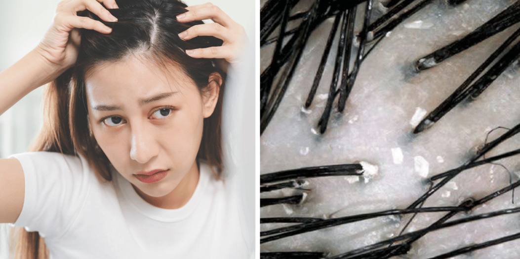 What’s Causing My Hair Loss & Dandruff? This $40 Treatment Is The Key ...