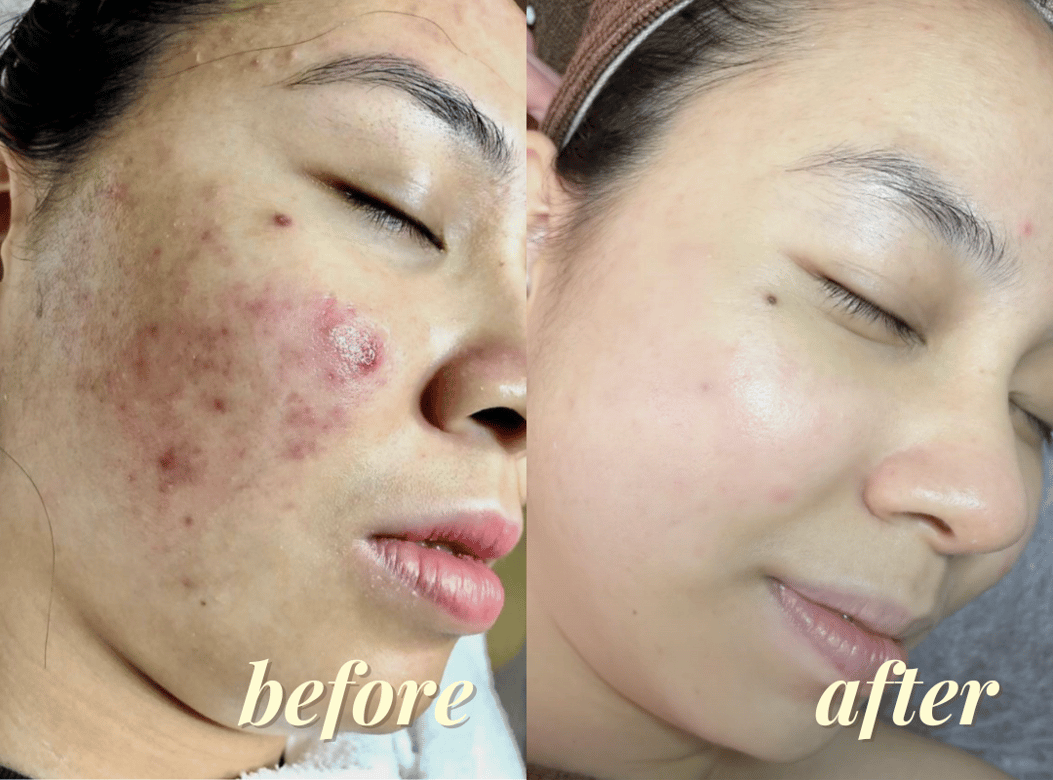 We Found The Best Pore Extraction Facial At My Cozy Room