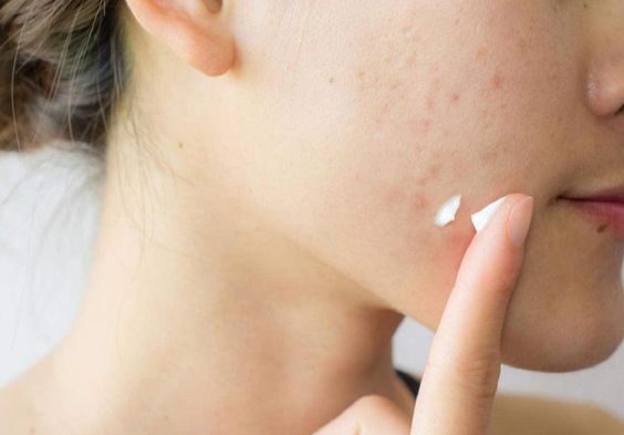 How To Get Rid Of Blind Pimples Effectively